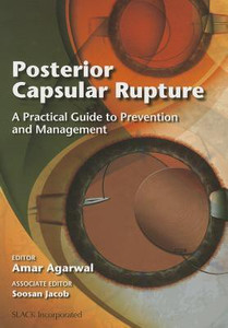 Posterior Capsular Rupture: Buy Posterior Capsular Rupture by Agarwal ...