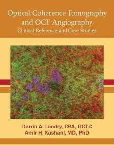 Optical Coherence Tomography and OCT Angiography: Buy Optical Coherence ...