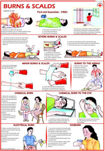 First Aid chart - Burns and Scalds Photographic Paper - Educational ...