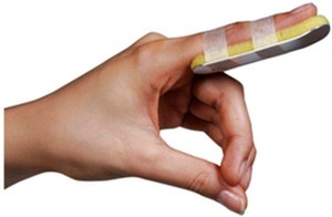 MGRM MEDICARE Spoon Splint |Helps In Fracture Management|Burns Care ...