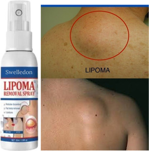 SWELLEDON Lipoma Removal Spray The Complete Solution for Lump Fat ...