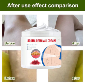 ONEAL Lipoma Remover Cream Painless Herbal Lipolysis Fat Relief Remover ...