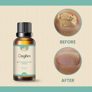 Oziglam Nail Fungus Repair And Recover Foot Toe Fungal Infection Oil ...