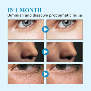 BNF Milia Remover Patch Sticker Moisturize Clean Skin For Fat Granules ...