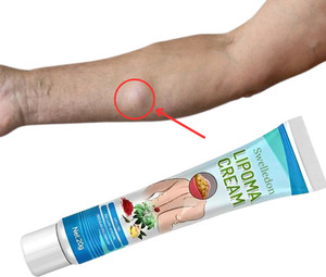 SWELLEDON Lipoma Removal Cream Lump Remover Neck Fat Removal Cream (20g ...
