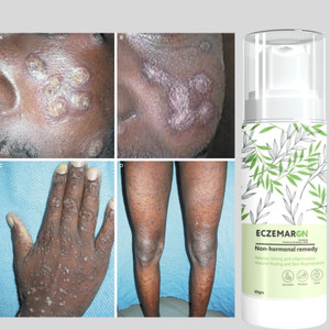 Eczemaron Ringworm Itching Anti fungal cream - for Ringworm, itching ...