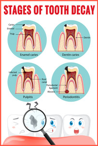 ShubhFly 48 cm Stages Of Tooth Decay Chart for Dental Clinic Poster ...